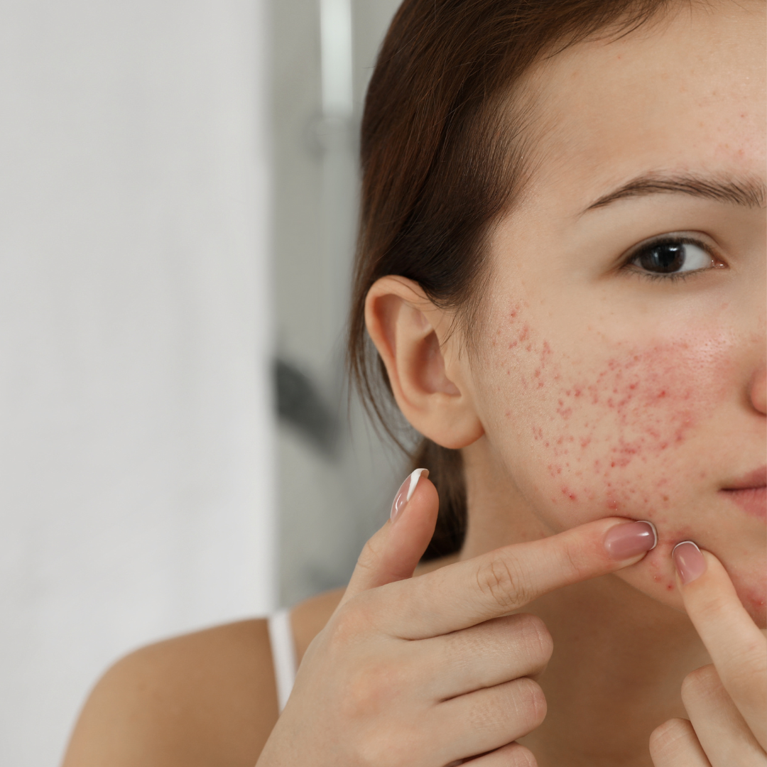 Pimples vs Severe Acne Differences - Healthhype