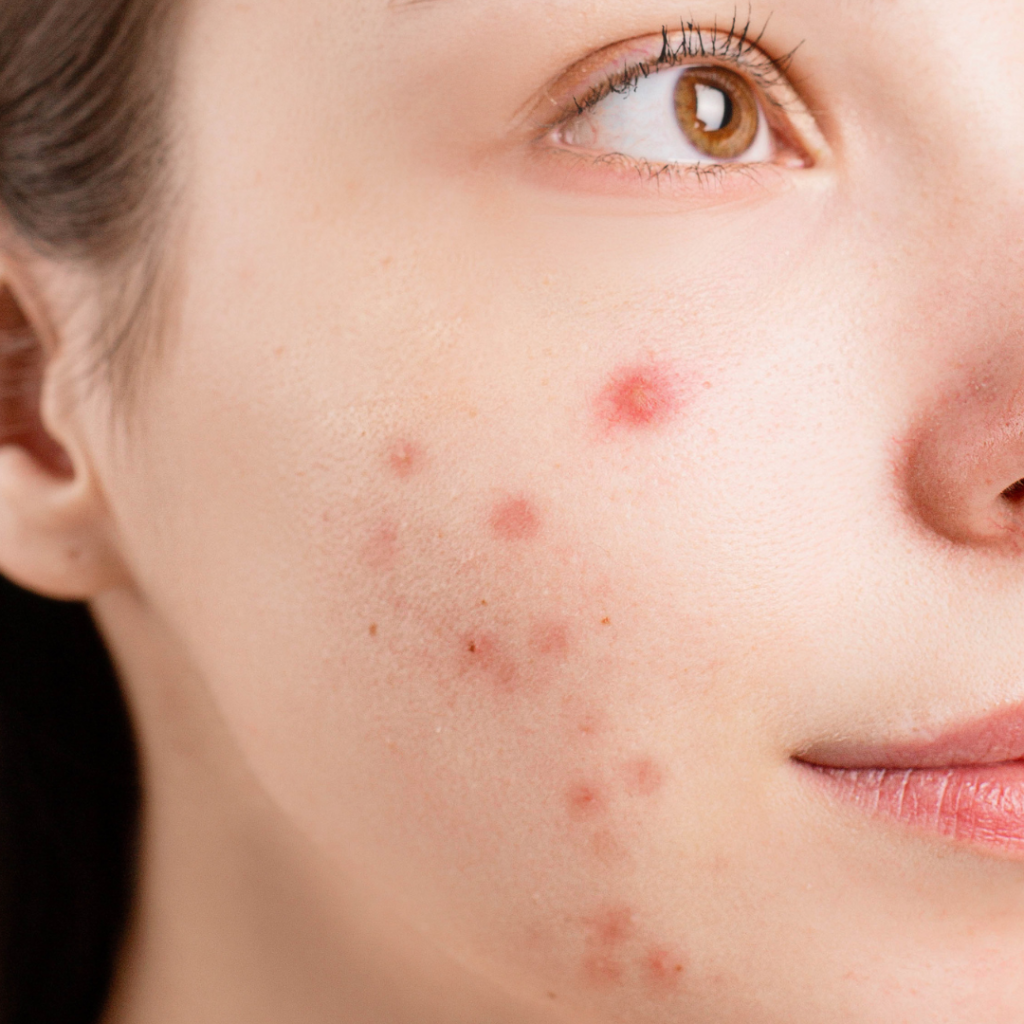 Makeup Cause Acne Clogged Pores: The Truth Revealed - Healthhype