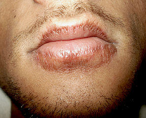 Dark Lips - Causes of Lip Discoloration (Brown, Black or Blue) - Healthhype