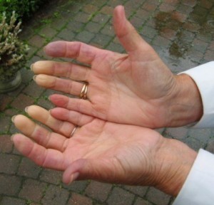 Blue Hands and Fingers Causes and Symptoms - Healthhype