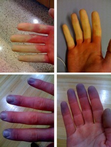 Blue Hands and Fingers Causes and Symptoms - Healthhype