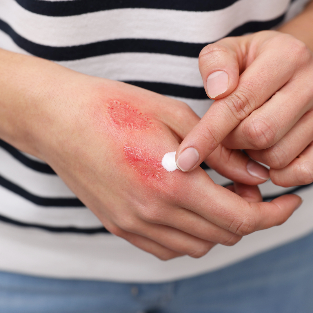 Burn First Aid Guide - Healthhype