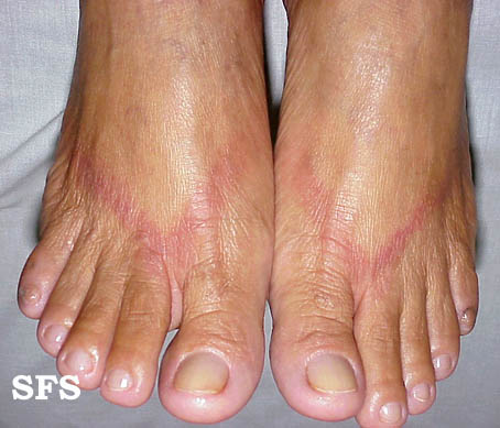 Irritant Contact Dermatitis - Causes, Pictures, Symptoms, Treatment ...