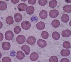 Thrombocytopenia Purpura (Low Platelets) - ITP, TTP, HUS, Heparin ...