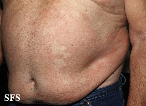 Tinea Versicolor (Neck, Chest, Back, Arm Skin Fungus) Pictures - Healthhype